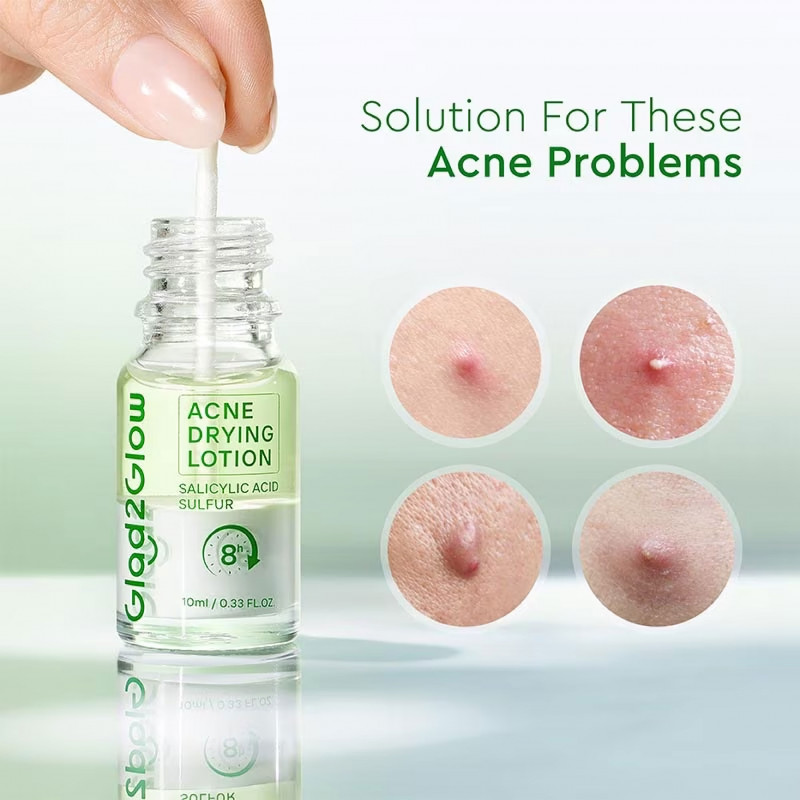 Promo Acne Drying Lotion FREE ONGKIR